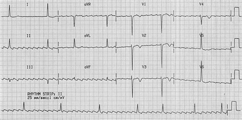 Flutter Predsieni Ekg Kniha Techmed