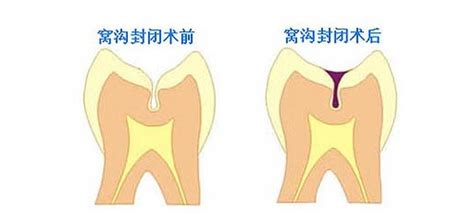 什么是窝沟封闭 爱康健齿科