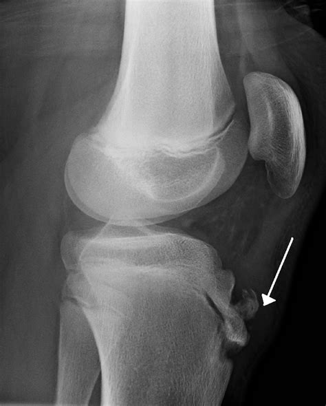 Osgood Schlatter Disease — Connect Physical Therapy
