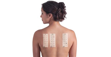 Allergy Patch Testing