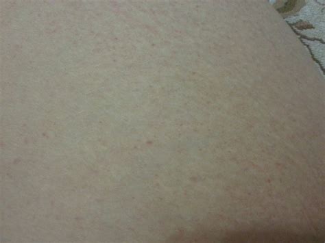 Ответы Маленькие красные точки на теле