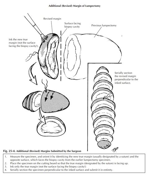 Breast Lumpectomy Surgical Pathology Dissection