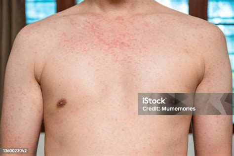 피부염 발진 바이러스 성 질병 면역 결핍 젊은 성인 아시아의 몸에 가려움증으로 스크래치 홍역에 대한 스톡 사진 및 기타 이미지 홍역 피부 거세포바이러스 Istock