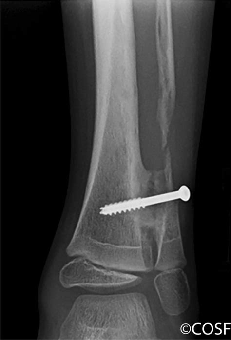 Anteroposterior Radiograph Showing A Tibiofibular Synostosis With Screw Download Scientific