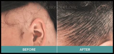 Smp Treatment Results Scalp Micropigmentation Crown Clinic