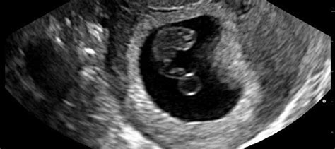 Hoe Echografie Van De Foetus Een Kindje Maakte Cultuurgeschiedenisbe