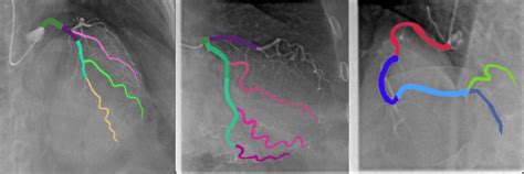 Segmentation Of Vessel Into Specific Regions According To The Syntax Download Scientific