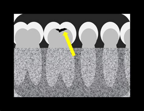 Caries Interpretation Occlusal Caries Dr Gs Toothpix