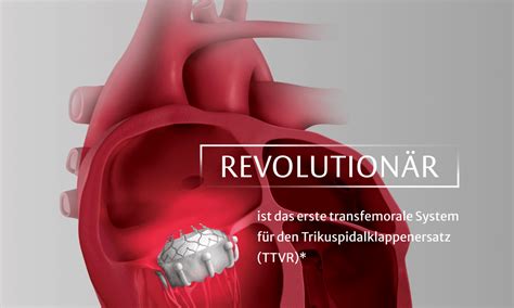 Evoque Trikuspidalklappenersatz Edwards Lifesciences