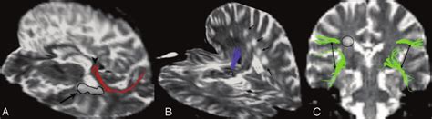 Callosal Projection And Association Fibers Passing Through Nawm A