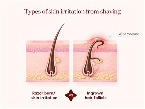 How To Get Rid Of Bikini Line Bumps Ingrown Hairs Razor Bumps And Irri