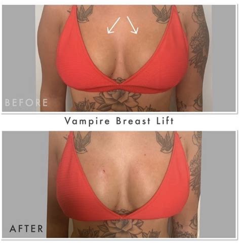 Do Breast Lifts Leave Scars At Jeniffer Rowe Blog