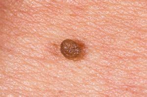 What Does Genital Warts Look Like On Lips