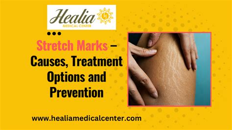 Stretch Marks Causes Stretch Marks Causes Prevention And Expert