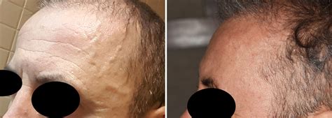 Clinic Snapshots Temporal Artery Ligation Outcomes Explore Plastic