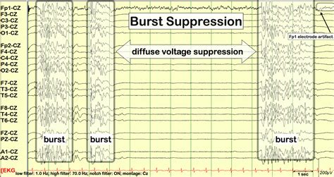 Burst Suppression