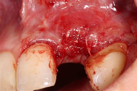 Block Augmentation With Maxgraft® In The Maxilla Botiss Biomaterials Gmbh