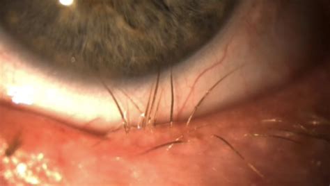 Ant Seg 1 Eyelid Disease Flashcards Quizlet