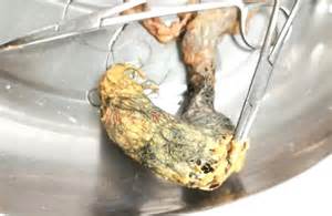 Hy Hữu Búi Tóc Dài 12 Cm Trong Ruột Bé Gái 4 Tuổi