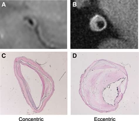 In Vitro Assessment Of Histology Verified Intracranial Atherosclerotic