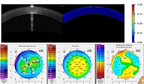 Figure 5 From Deep Learning Model For The Detection Of Corneal Edema Before Descemet Membrane