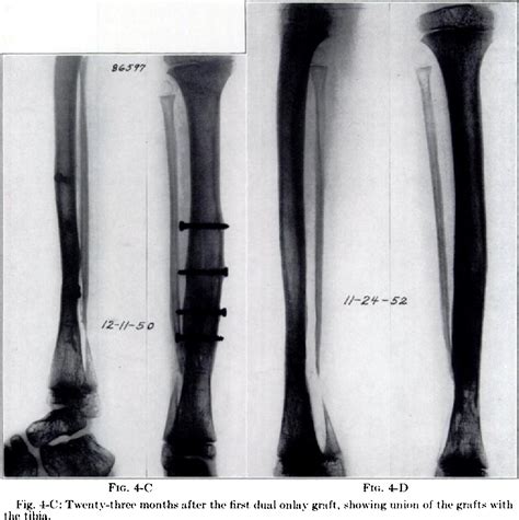 Figure 1 From Congenital Pseudarthrosis Of The Tibia Semantic Scholar