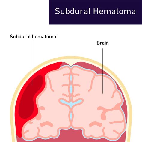 Intracranial Hematoma Hemorrhagic Stroke What It Is Symptoms