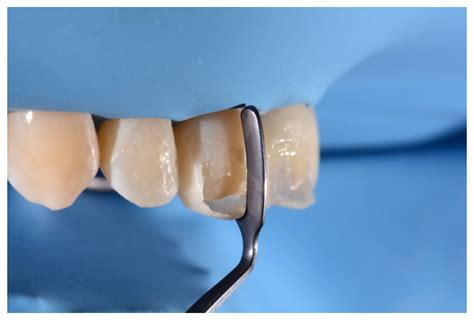 Anterior Composite Matrix System At Milla Slessor Blog