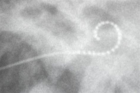 Cochlear Implant Program Queensland Otology