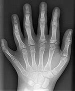 Polydactyly Wikipedia