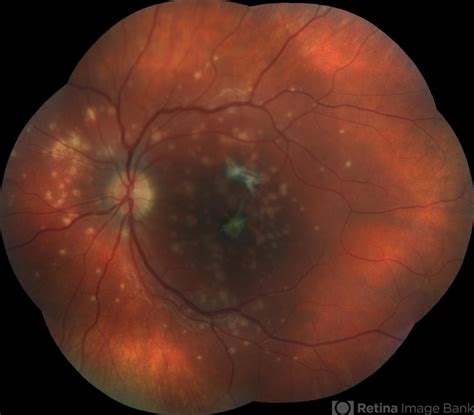 Punctate Inner Choroidopathy Vision Loss Causing Disease