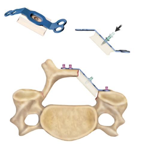 Product Detail Neurospine