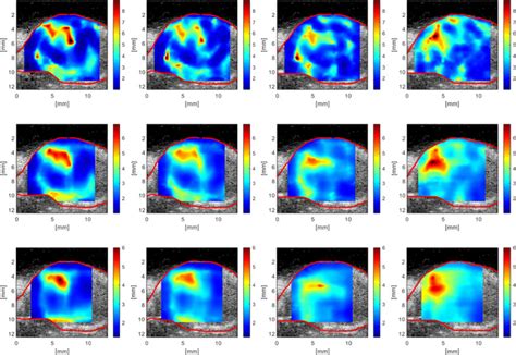 Estimated Shear Wave Speed M S⁻¹ In Ex Vivo Tumour For Frequencies Of