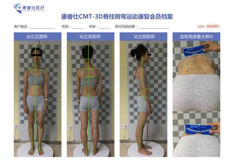 康睿仕脊柱侧弯案例分享:23岁教师经物理治疗疼痛消失身姿挺拔骨盆 康睿仕脊柱侧弯案例分享:23岁教师经物理治疗疼痛消失身姿挺拔骨盆