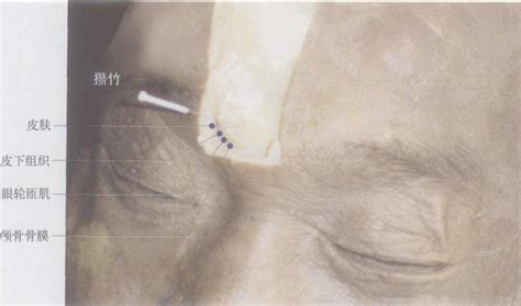 图8 2攒竹穴层次显示切面 中医学 医学