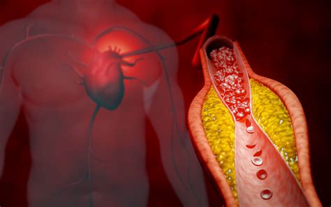 Inclisiran Receives Fda Approval For New Indication To Treat