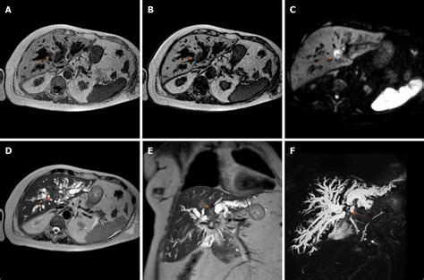 Gadoxetic Acid Magnetic Enhanced Resonance Imaging In The Diagnosis Of Cholangiocarcinoma