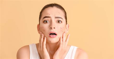 Acne 101 Causes Types And How To Manage Vancouver Laser And Skin