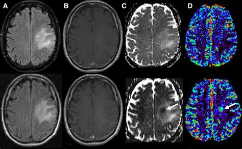 Initial Upper Row And Follow Up Mri Lower Row Examination After
