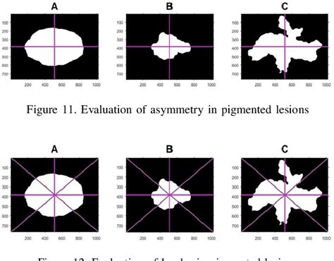 Figure 11 From Computer Aided Diagnosis Of Melanoma Based On The Abcd Rule Semantic Scholar