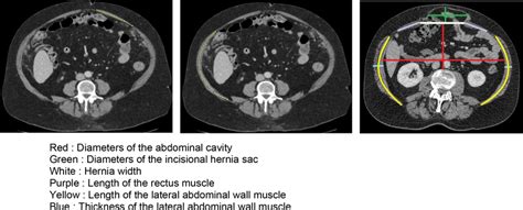 Ct Scan Measurements Via Imagej® Software Download Scientific Diagram