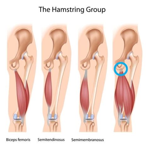 Shockwave Therapy For Proximal Hamstring Tendinopathy Complete Physio