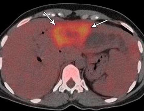 Cholangiocarcinoma Current And Novel Imaging Techniques RadioGraphics