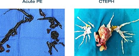 Chronic Thromboembolic Pulmonary Hypertension Cteph Cardiopulmonary Disease Education