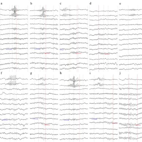 Pdf The Intracranial Correlate Of The 14and6sec Positive Spikes Normal