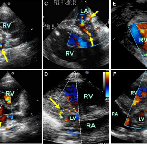 Two Dimensional Echocardiograms From Four Patients A Parasternal Download Scientific Diagram
