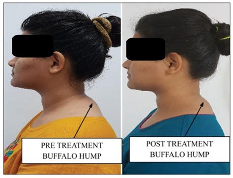Cushing Syndrome Buffalo Hump At Betty Love Blog