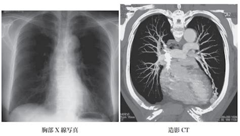 肺動静脈奇形 瘻とは？画像診断のポイントは？