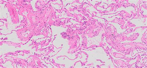 Human Lung Tissue Normal Ffpe Sections