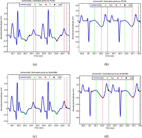 Figure 1 From Ecg Segmentation And Fiducial Point Extraction Using Multi Hidden Markov Model
